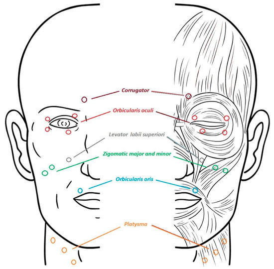 Botulinum Toxin for the Treatment of Hemifacial Spasm: An Update on ...