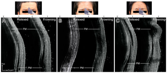 Anatomical Injection Guidelines for Glabellar Frown Lines Based on ...
