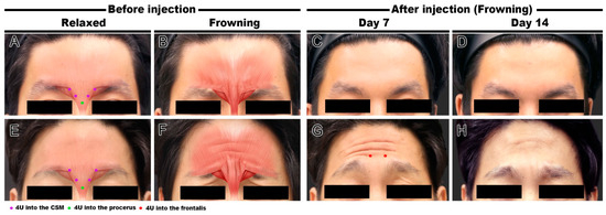 Anatomical Injection Guidelines for Glabellar Frown Lines Based on ...