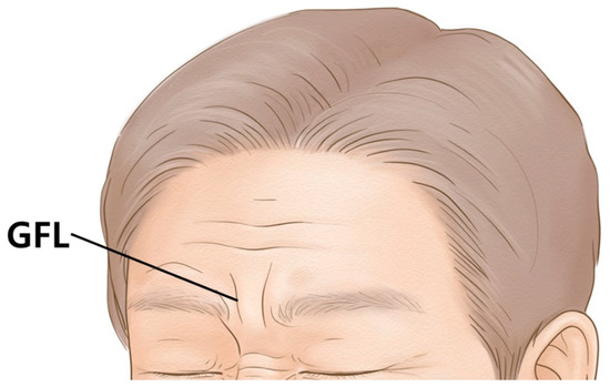 Anatomical Proposal for Botulinum Neurotoxin Injection for Glabellar ...