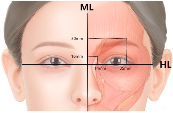 Anatomical Proposal for Botulinum Neurotoxin Injection for Glabellar ...