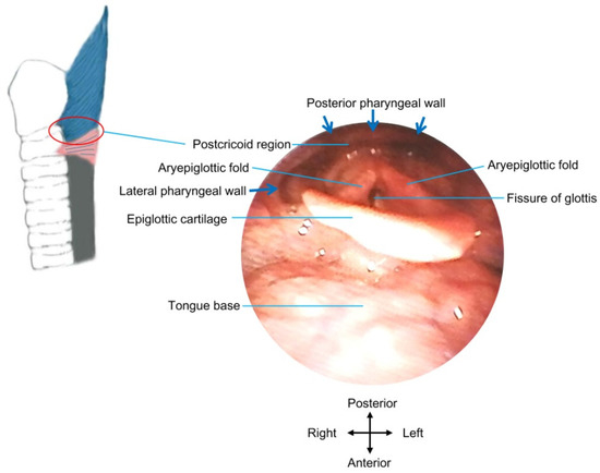Botulinum Toxin Injection for the Treatment of Upper Esophageal ...