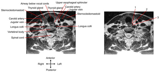 Botulinum Toxin Injection for the Treatment of Upper Esophageal ...