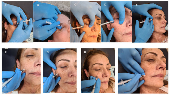 Therapeutic Approach to Botulinum Injections for Hemifacial Spasm ...