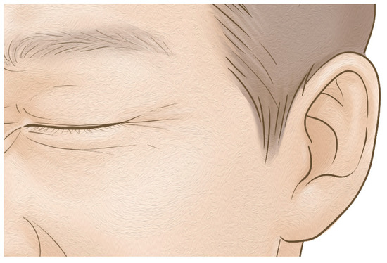 Novel Anatomical Proposal for Botulinum Neurotoxin Injection Targeting ...