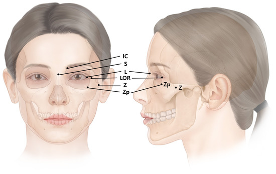 Novel Anatomical Proposal for Botulinum Neurotoxin Injection Targeting ...