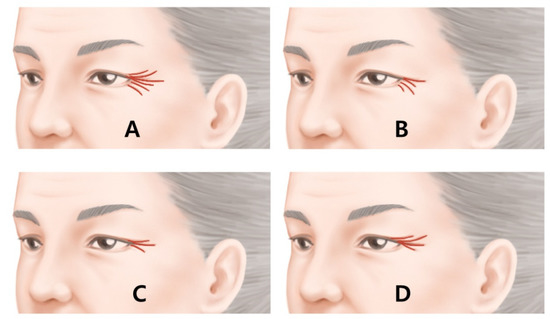 Novel Anatomical Proposal for Botulinum Neurotoxin Injection Targeting ...