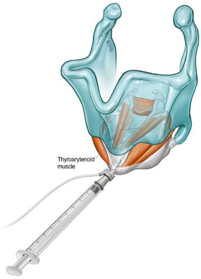 Botulinum Neurotoxin Therapy in the Clinical Management of Laryngeal ...