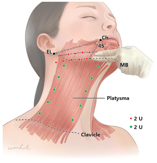 Anatomical Proposal for Botulinum Neurotoxin Injection Targeting the ...