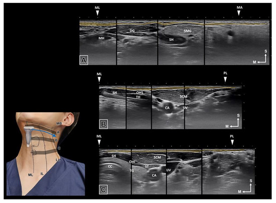 Anatomical Proposal for Botulinum Neurotoxin Injection Targeting the ...