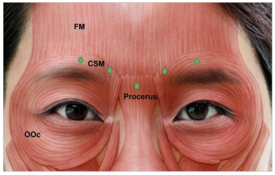 Cosmetic Treatment Using Botulinum Toxin in the Oral and Maxillofacial ...