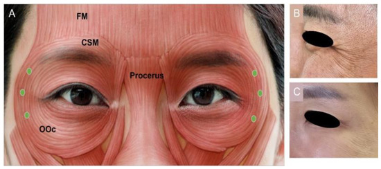 Cosmetic Treatment Using Botulinum Toxin in the Oral and Maxillofacial ...