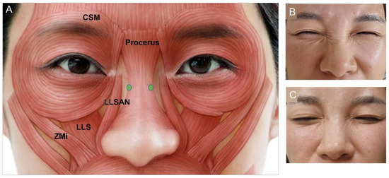 Cosmetic Treatment Using Botulinum Toxin in the Oral and Maxillofacial ...