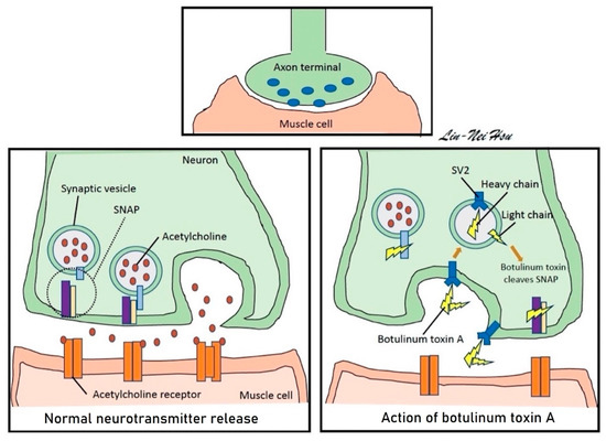 Toxins | Free Full-Text | Role of Urological Botulinum Toxin-A ...