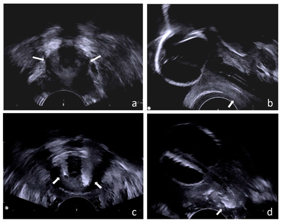The Efficacy of Transvaginal Ultrasound-Guided BoNT-A External ...