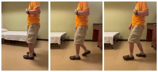 Stiff Knee Gait Disorders as Neuromechanical Consequences of Spastic ...