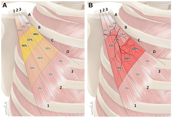 Ideal Injection Points for Botulinum Neurotoxin for Pectoralis Minor ...