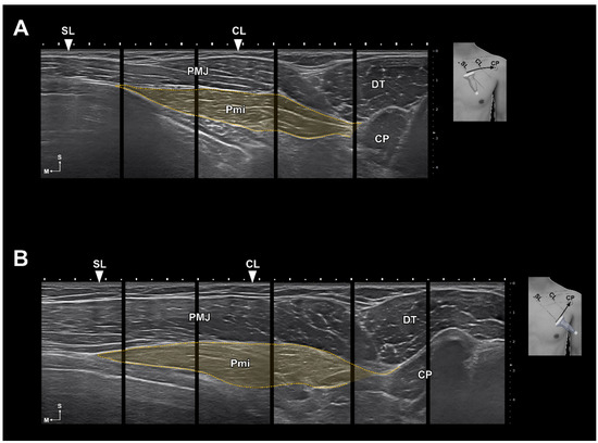 Ideal Injection Points for Botulinum Neurotoxin for Pectoralis Minor ...