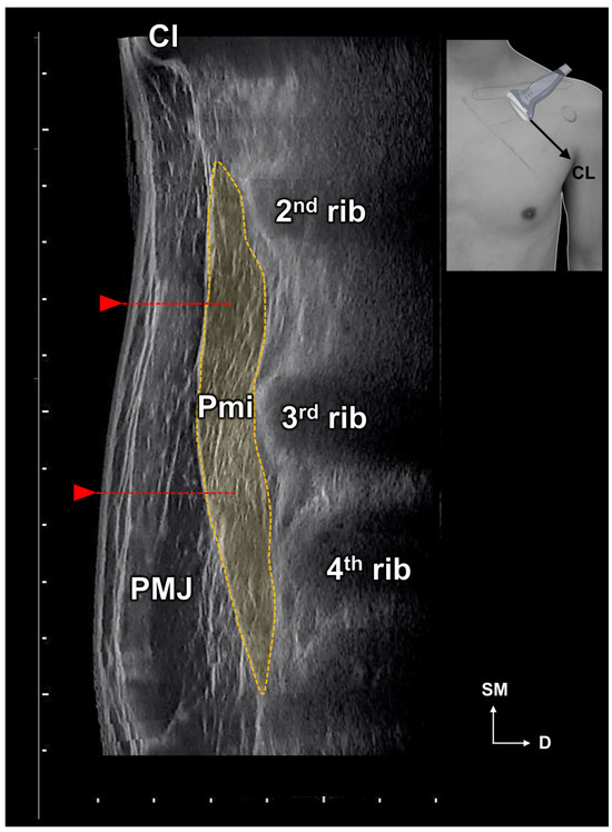 Ideal Injection Points for Botulinum Neurotoxin for Pectoralis Minor ...
