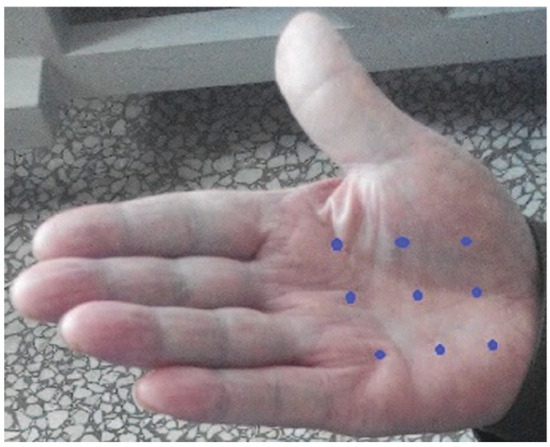 Botulinum Toxin Treatment for Cancer-Related Disorders: A Systematic Review