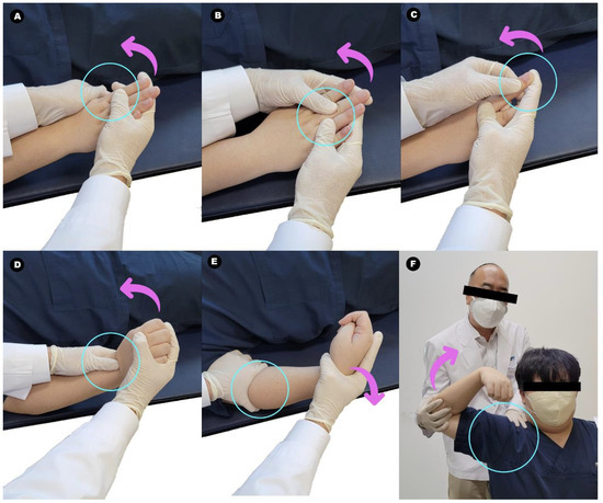 Long-Term Enhancement of Botulinum Toxin Injections for Post-Stroke ...