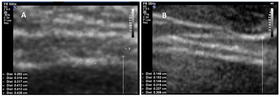 Strategies for Safe Transurethral Injections of Botulinum Toxin into ...