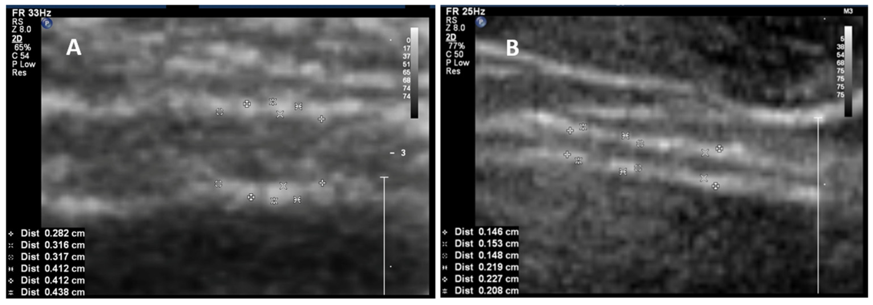 Strategies for Safe Transurethral Injections of Botulinum Toxin into ...