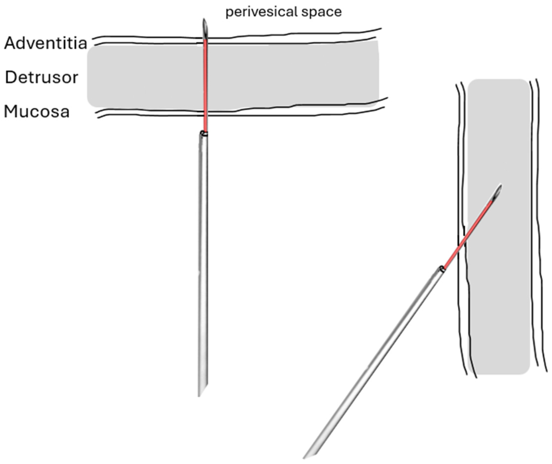 Strategies for Safe Transurethral Injections of Botulinum Toxin into ...