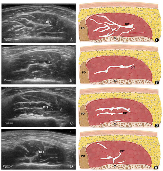 An Ultrasonographic Analysis of the Deep Inferior Tendon in the ...