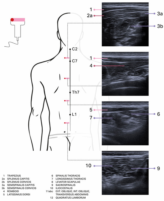 Case Series and Literature Review on Botulinum Toxin Efficacy in Axial ...