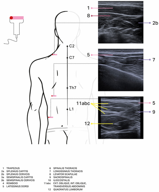 Case Series and Literature Review on Botulinum Toxin Efficacy in Axial ...