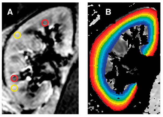 Blood Oxygen Level-Dependent (BOLD) MRI in Glomerular Disease