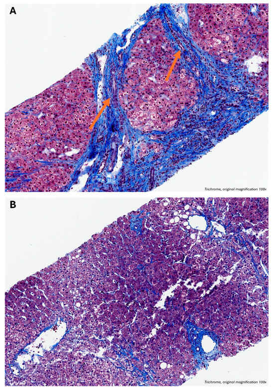 Challenging the Dogma: Reversal of End-Stage Liver Fibrosis with ...