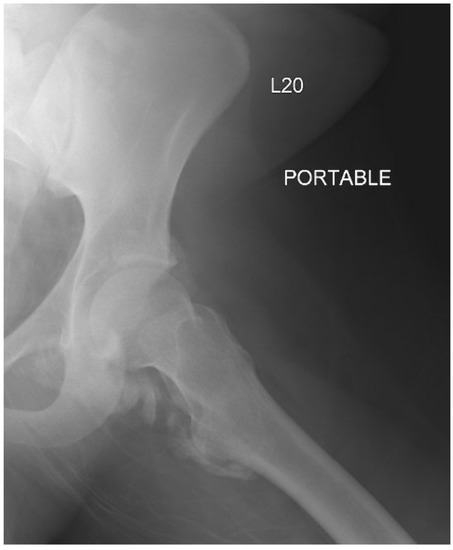 Heterotopic Ossification after a Prolonged Course of COVID-19: A Case ...