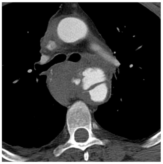 Evaluation of a Standardized Severity Grading System for Blunt Thoracic ...