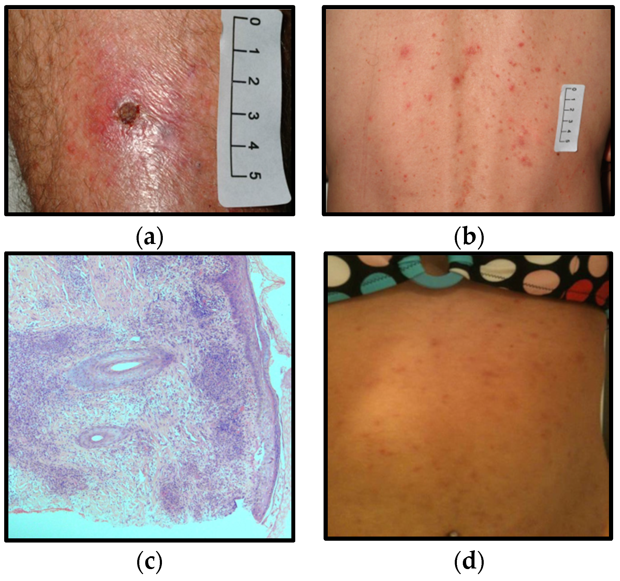 New Foci of Spotted Fever Group Rickettsiae Including Rickettsia honei ...