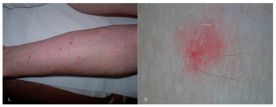 TropicalMed | Special Issue : Skin-Related Neglected Tropical Diseases ...