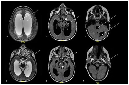 Mastoid Air Cells Mri