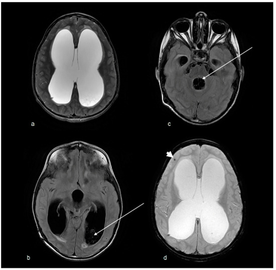Disseminated Human Subarachnoid Coenurosis