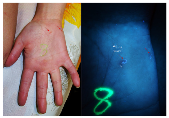 Facilitations in the Clinical Diagnosis of Human Scabies through the ...