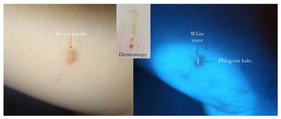 Facilitations in the Clinical Diagnosis of Human Scabies through the ...