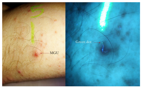 Facilitations in the Clinical Diagnosis of Human Scabies through the ...
