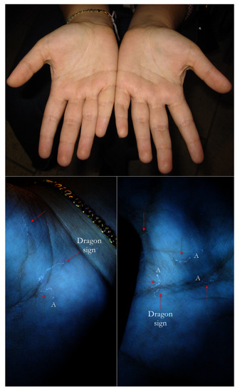 Facilitations in the Clinical Diagnosis of Human Scabies through the ...
