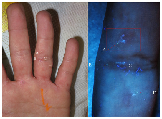 Facilitations in the Clinical Diagnosis of Human Scabies through the ...