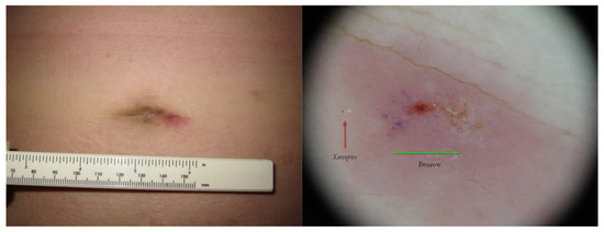 Facilitations in the Clinical Diagnosis of Human Scabies through the ...
