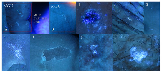 Facilitations in the Clinical Diagnosis of Human Scabies through the Use of Ultraviolet Light ...