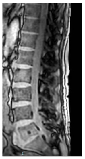Endocarditis with Streptococcus pseudoporcinus Associated with ...