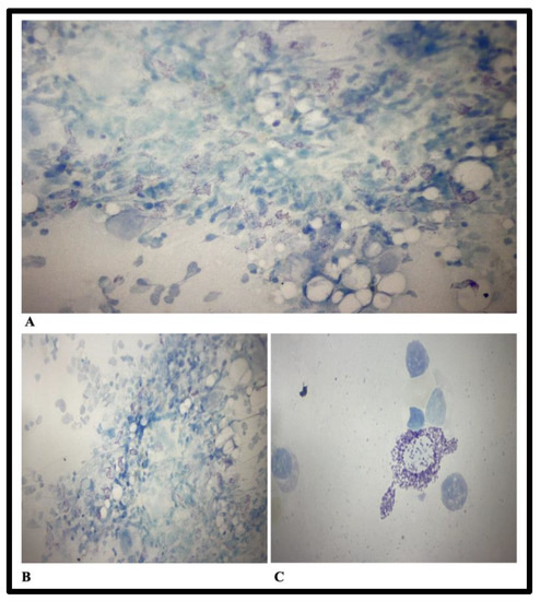 Endocarditis with Streptococcus pseudoporcinus Associated with ...
