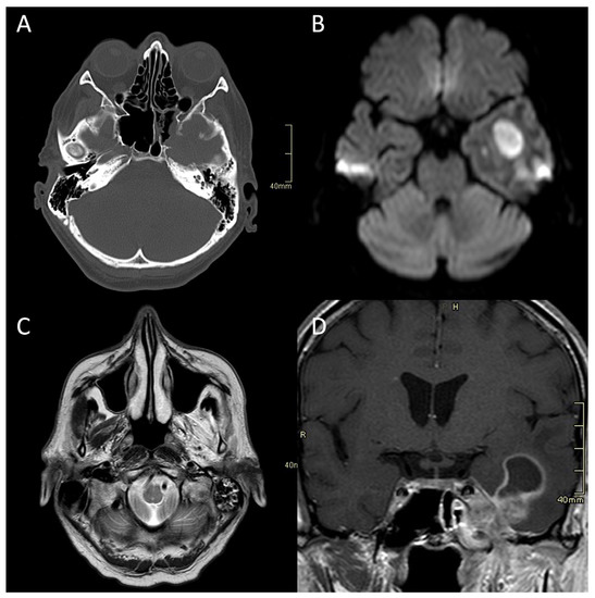 Atypical Skull-Base Osteomyelitis: Comprehensive Review and ...