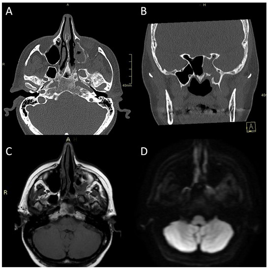Atypical Skull-Base Osteomyelitis: Comprehensive Review and ...